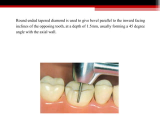 Full crown preparation | PPT