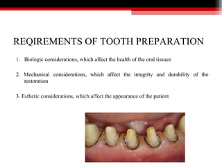 Tooth Crown Preparation