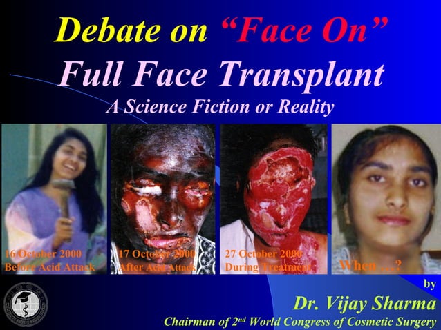 Full face transplant | PPT