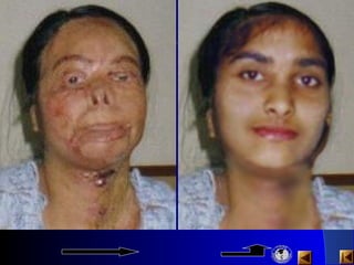 Full face transplant | PPT