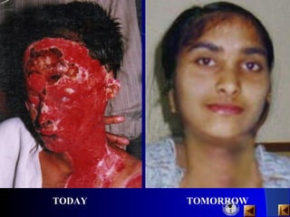 Full face transplant | PPS