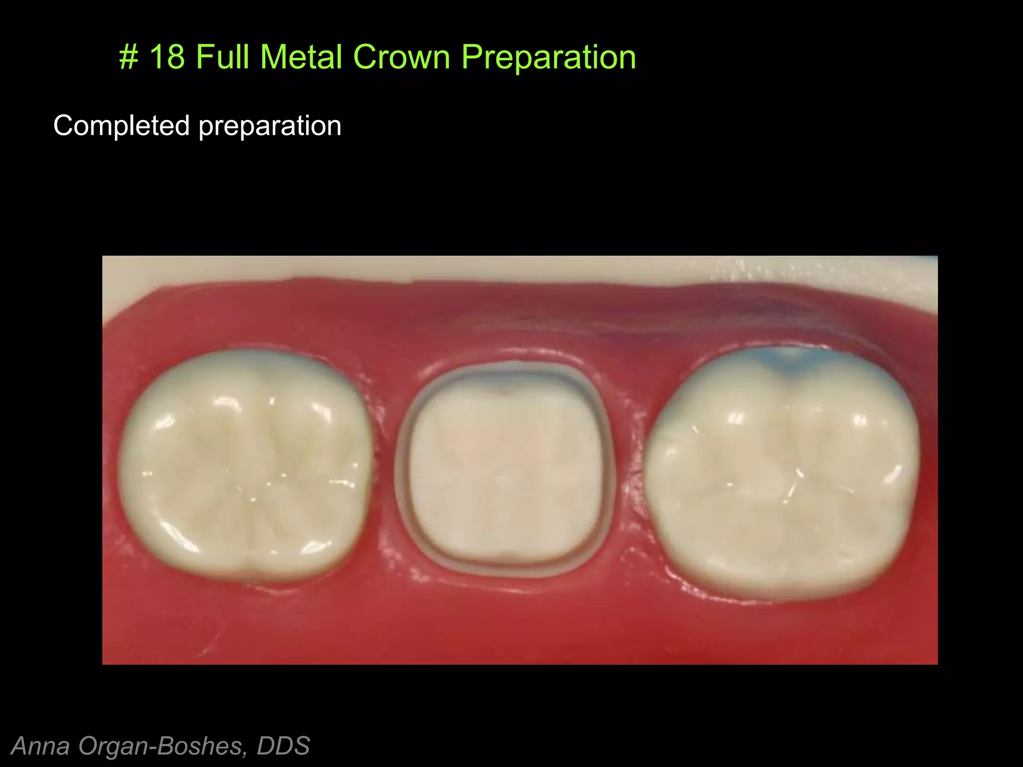 Full gold crown preparation | PPT