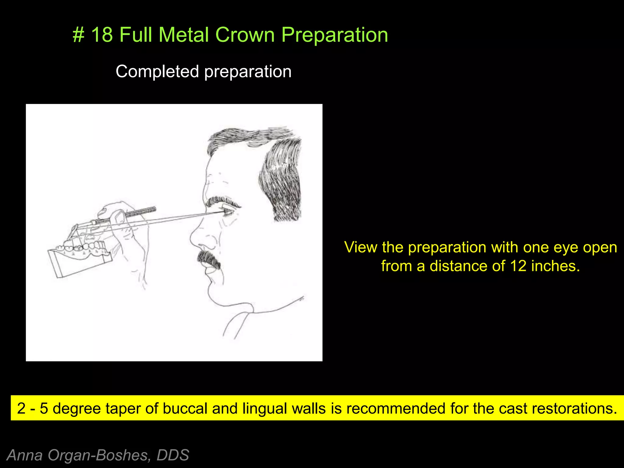 Full gold crown preparation | PPT