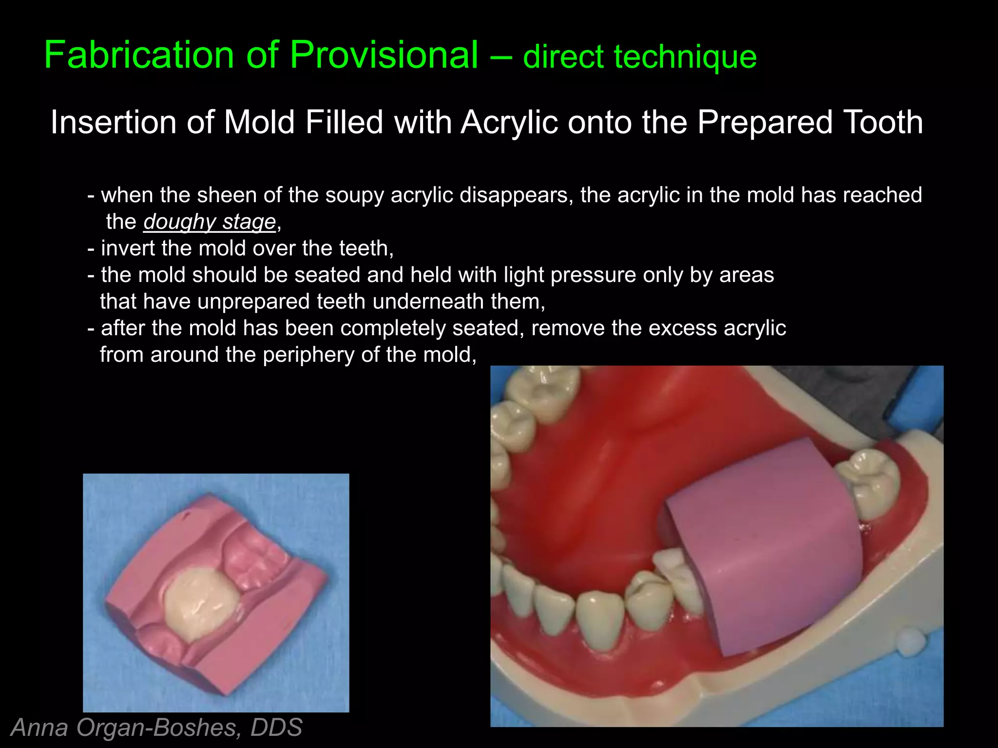 Full gold crown preparation | PPT