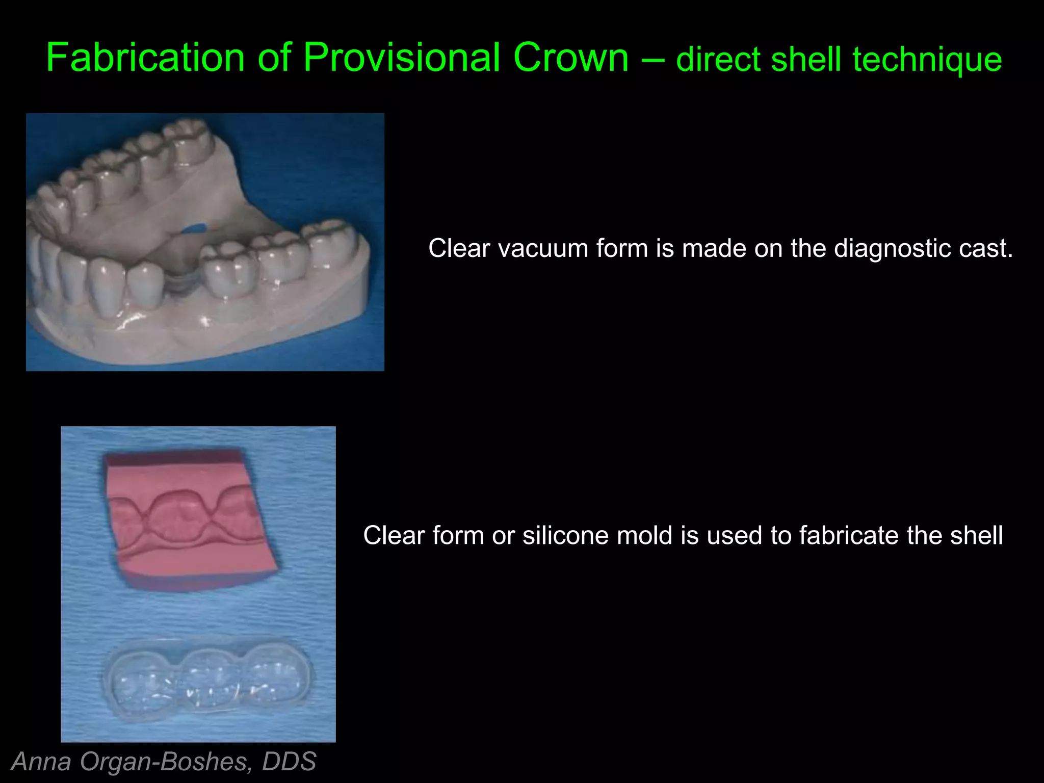 Full gold crown preparation | PPT