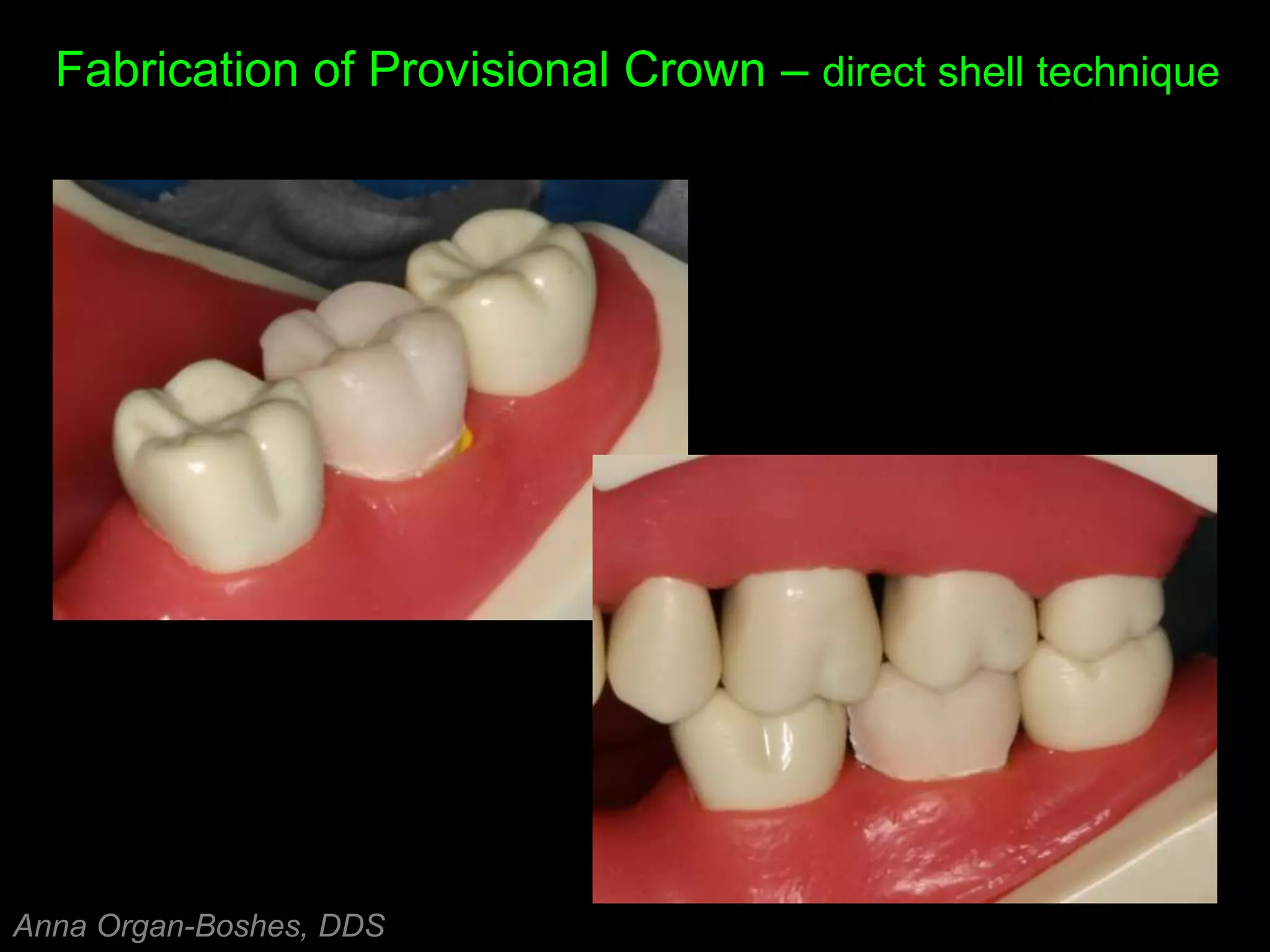 Full gold crown preparation | PPT