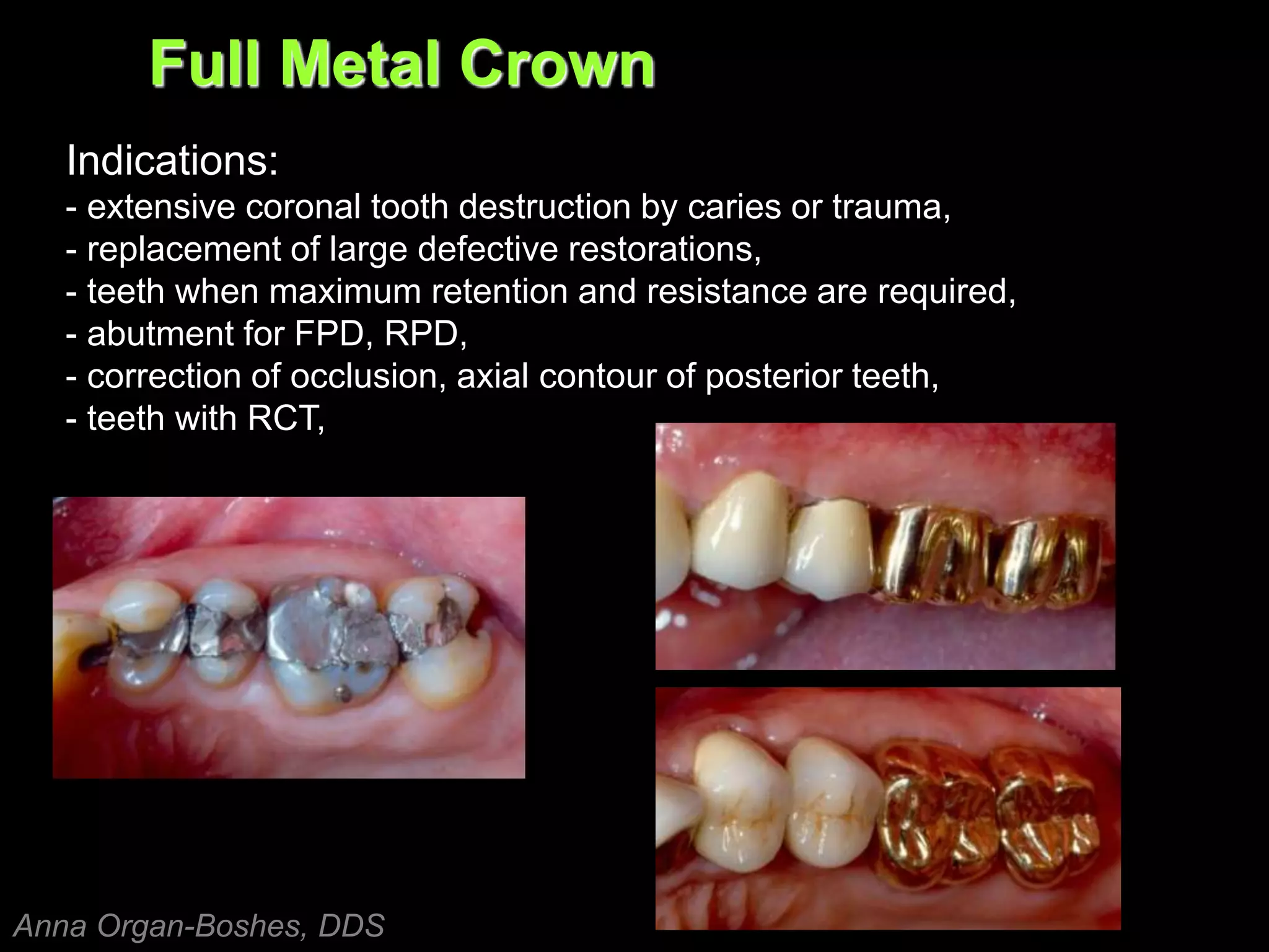 Full gold crown preparation | PPT