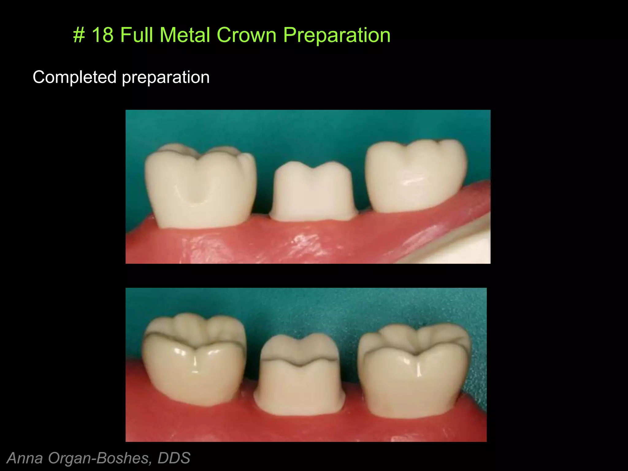 Full gold crown preparation | PPT