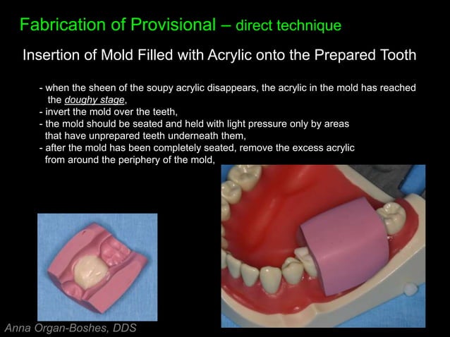 Full gold crown preparation | PPT | Dental Health | Diseases and Conditions