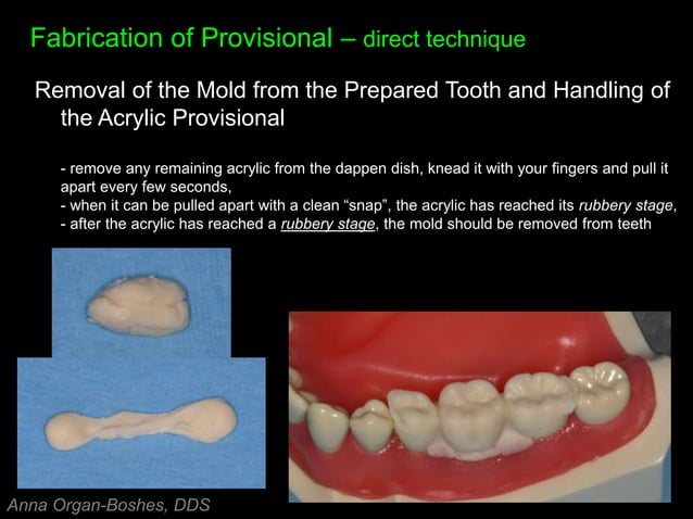 Full gold crown preparation | PPT | Dental Health | Diseases and Conditions