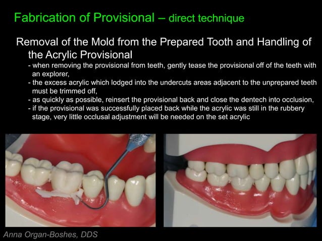 Full gold crown preparation | PPT | Dental Health | Diseases and Conditions
