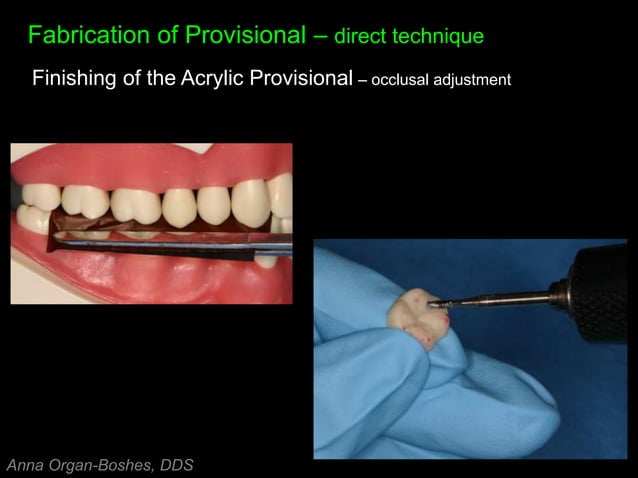 Full gold crown preparation | PPT | Dental Health | Diseases and Conditions