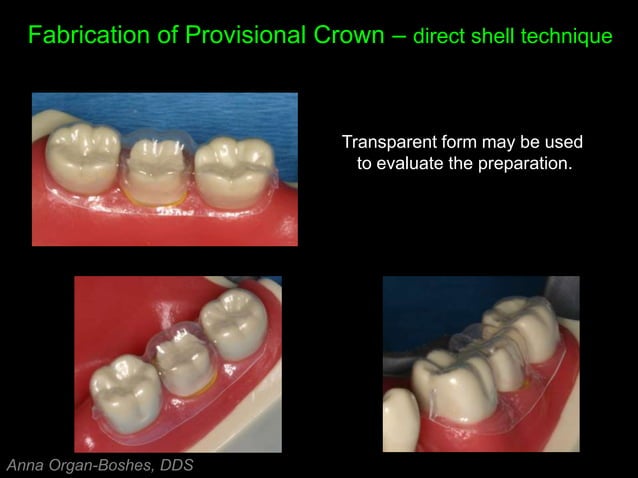 Full gold crown preparation | PPT | Dental Health | Diseases and Conditions