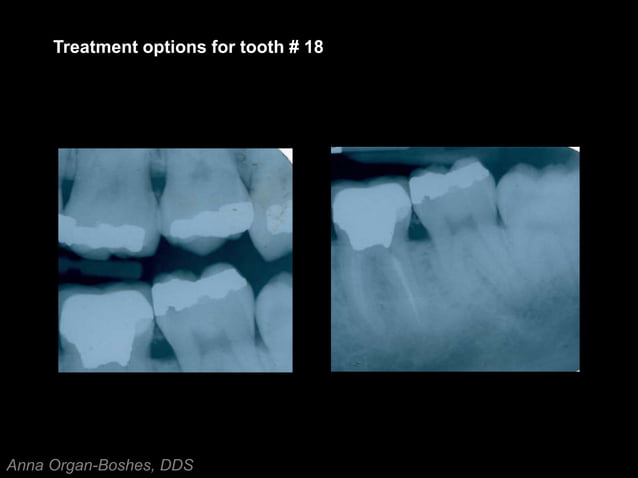 Full gold crown preparation | PPT | Dental Health | Diseases and Conditions