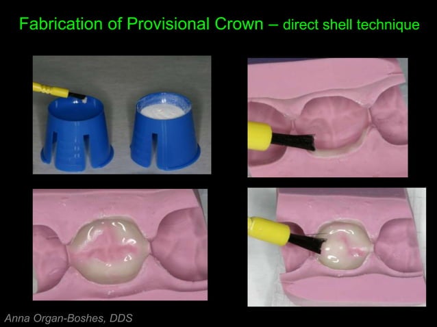 Full gold crown preparation | PPT | Dental Health | Diseases and Conditions