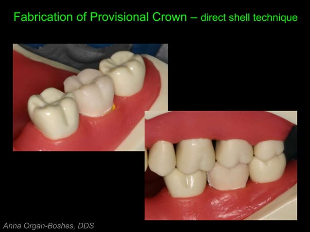 Full gold crown preparation | PPT