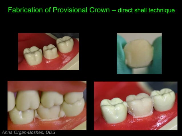Full gold crown preparation | PPT | Dental Health | Diseases and Conditions