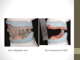 Full mouth fixed implant rehabilitation in a patient | PPTX