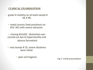 Full mouth fixed implant rehabilitation in a patient | PPTX