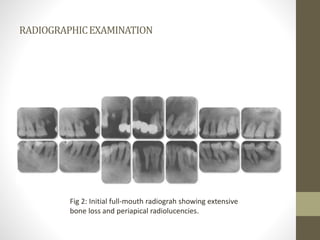 Full mouth fixed implant rehabilitation in a patient | PPTX