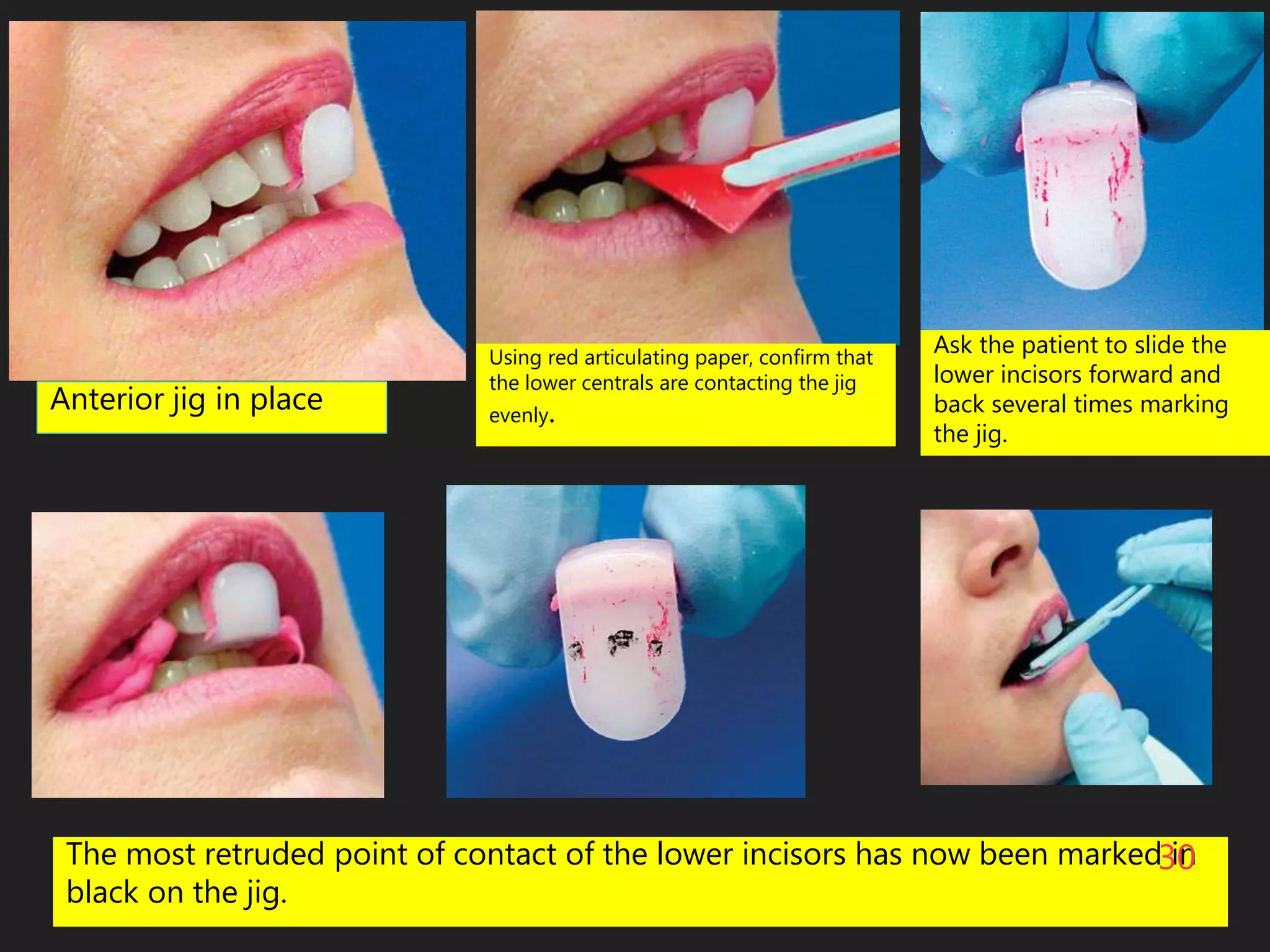 full mouth rehabilitation 1021.pptx