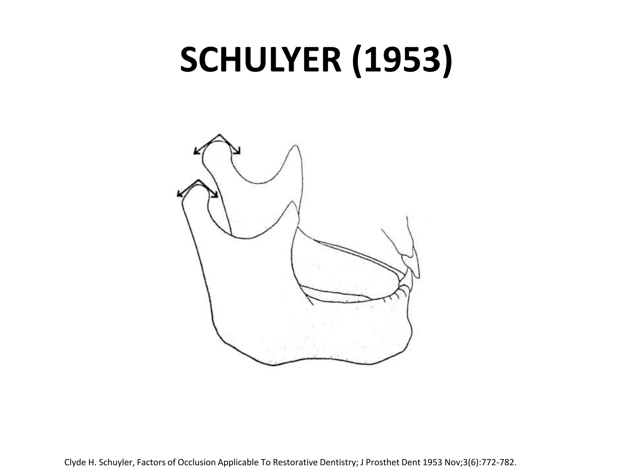 Full mouth rehabilitation using pankey mann schulyer technique | PPTX