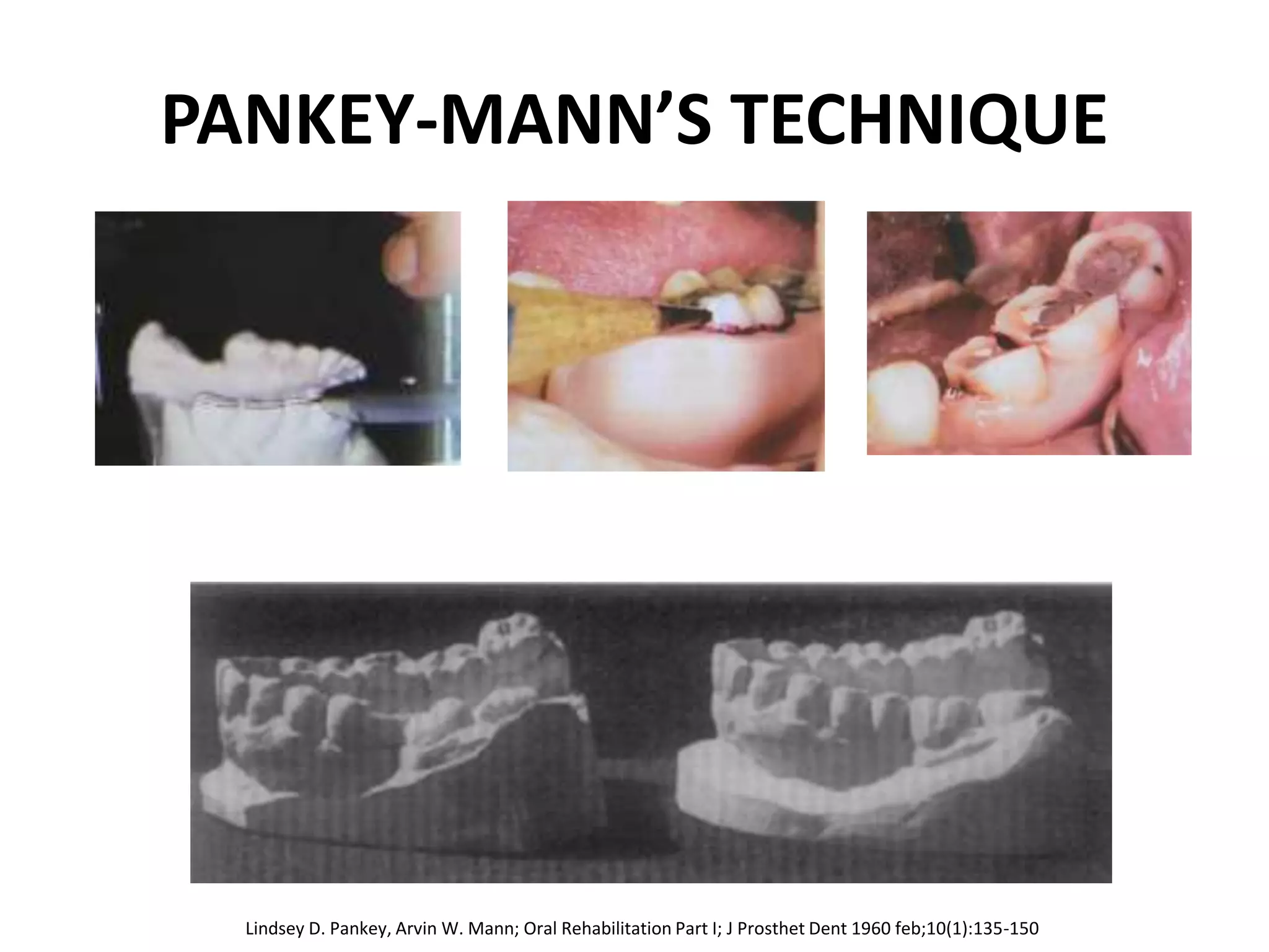 Full mouth rehabilitation using pankey mann schulyer technique | PPTX