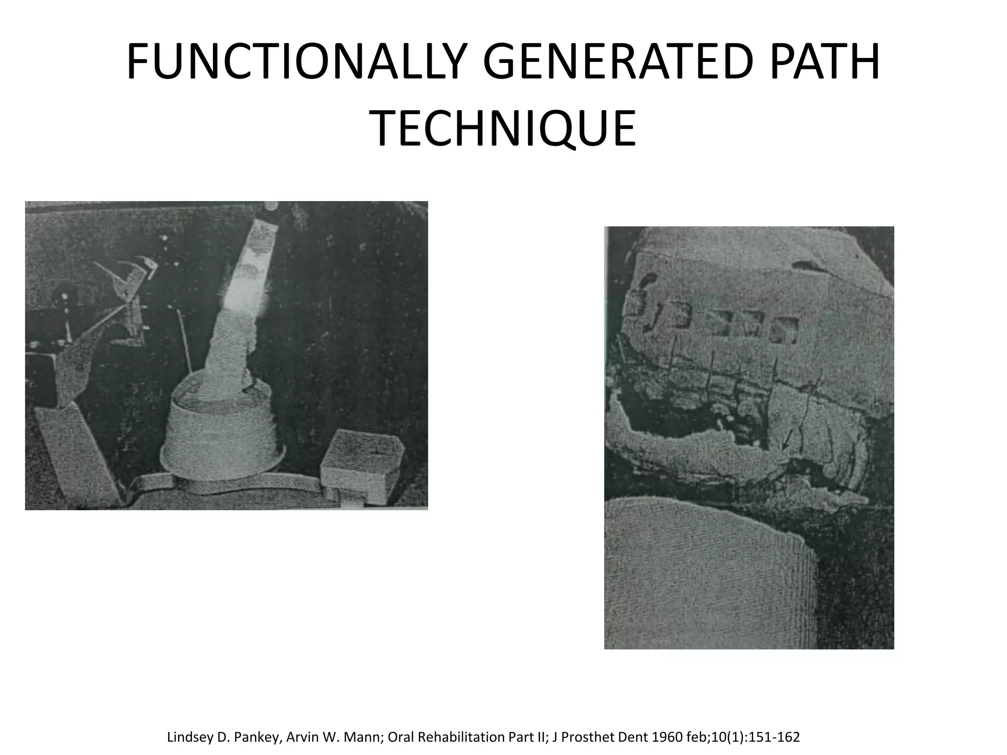 Full mouth rehabilitation using pankey mann schulyer technique | PPTX