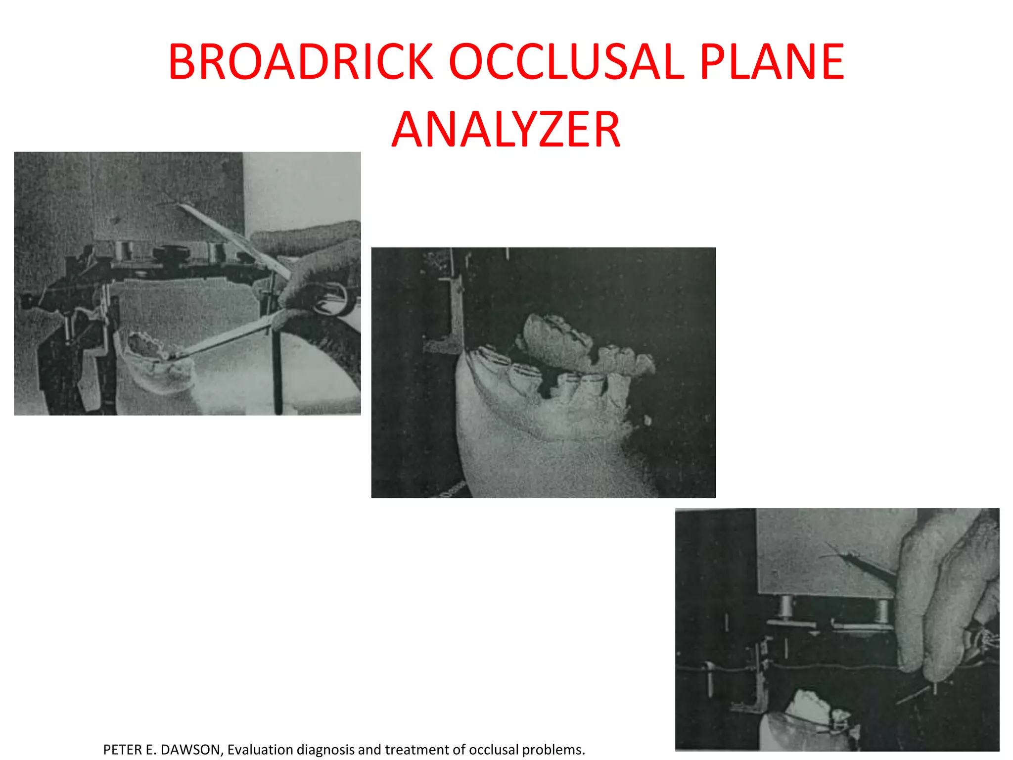Full mouth rehabilitation using pankey mann schulyer technique | PPTX
