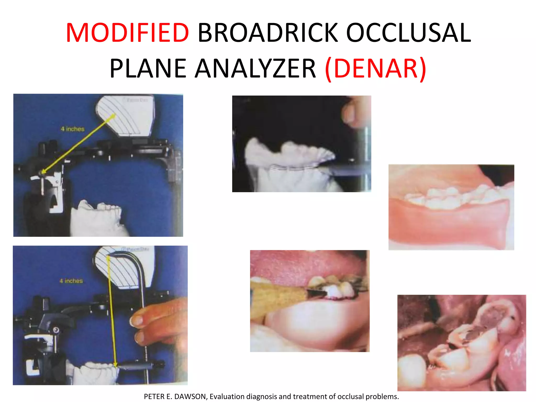 Full mouth rehabilitation using pankey mann schulyer technique | PPTX