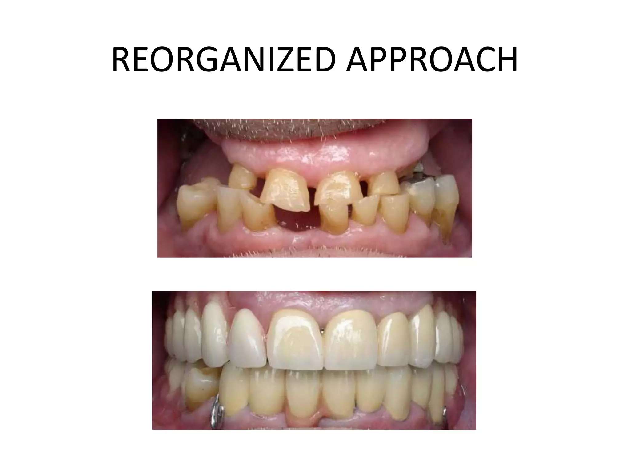 Full mouth rehabilitation using pankey mann schulyer technique | PPTX