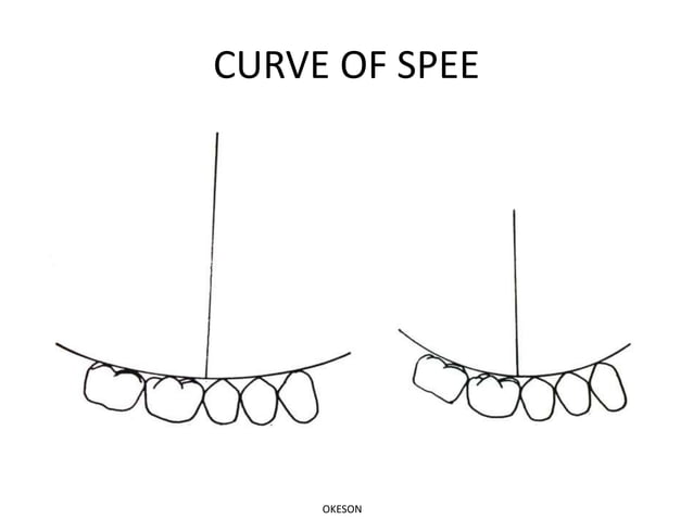 Full mouth rehabilitation using pankey mann schulyer technique | PPTX