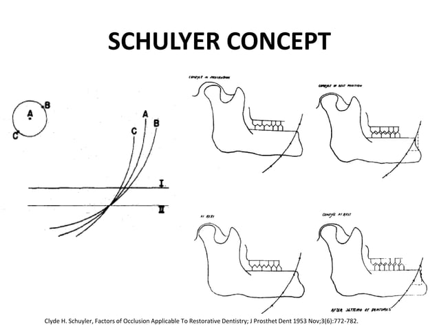 Full mouth rehabilitation using pankey mann schulyer technique | PPTX