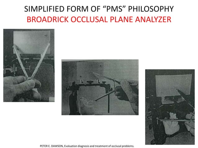 Full mouth rehabilitation using pankey mann schulyer technique | PPTX