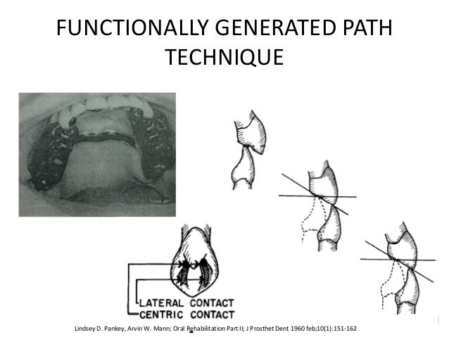 Full mouth rehabilitation using pankey mann schulyer technique
