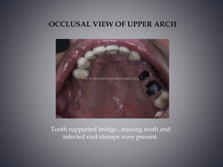 Full mouth rehabilitation with dental implants - a case report in india ...