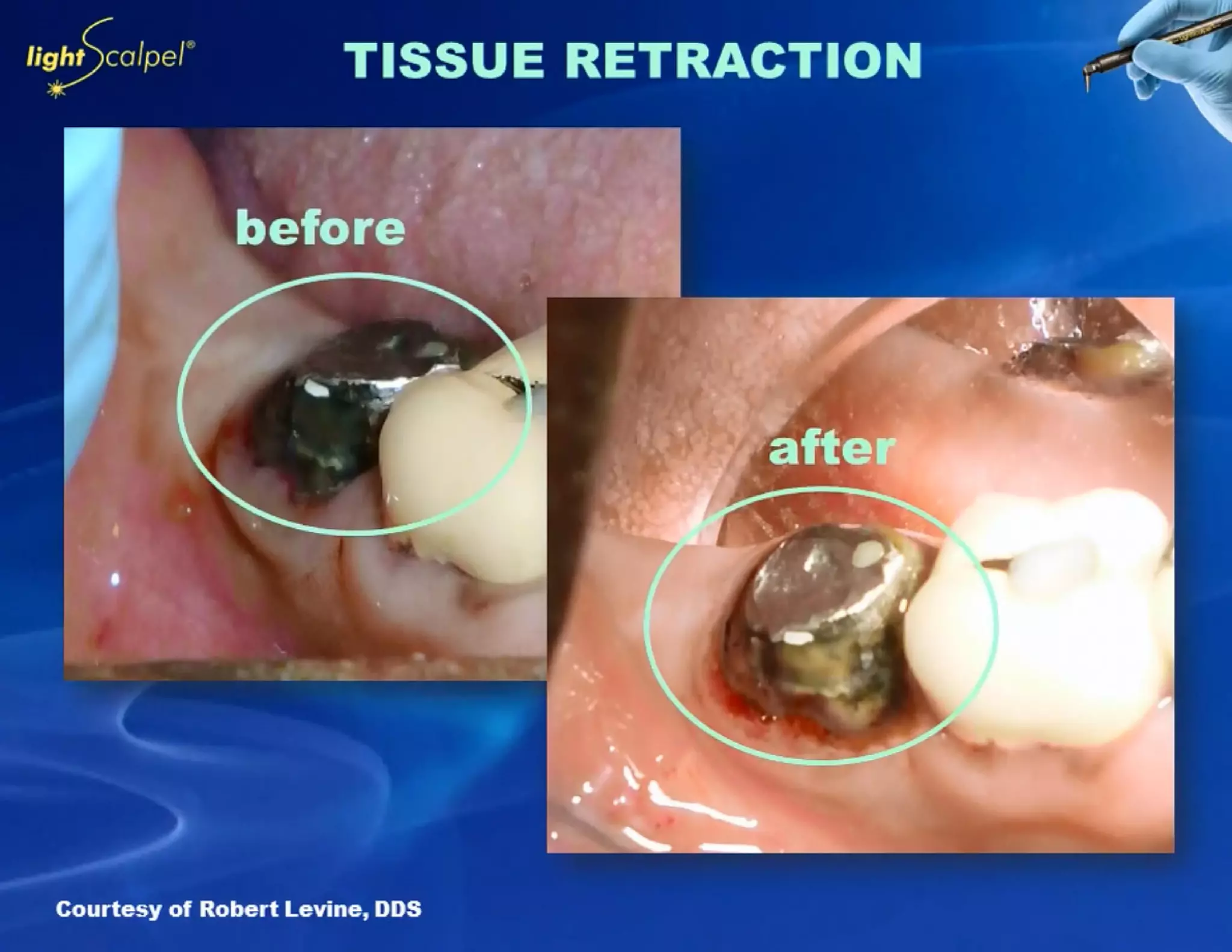 Laser tissue retraction for crown & bridge impressions | PDF
