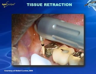 Laser tissue retraction for crown & bridge impressions | PPT