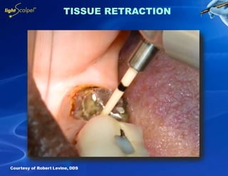 Laser tissue retraction for crown & bridge impressions | PPT