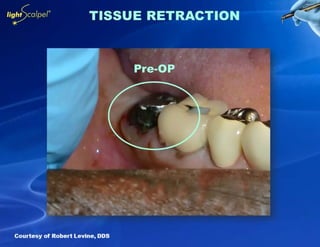 Laser tissue retraction for crown & bridge impressions | PPT
