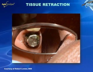 Laser tissue retraction for crown & bridge impressions | PPT