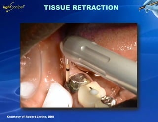 Laser tissue retraction for crown & bridge impressions | PPT
