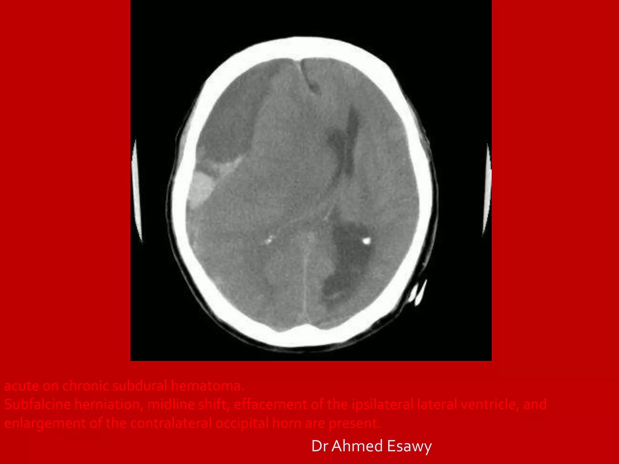 Full story brain herniation imaging Dr Ahmed Esawy | PDF