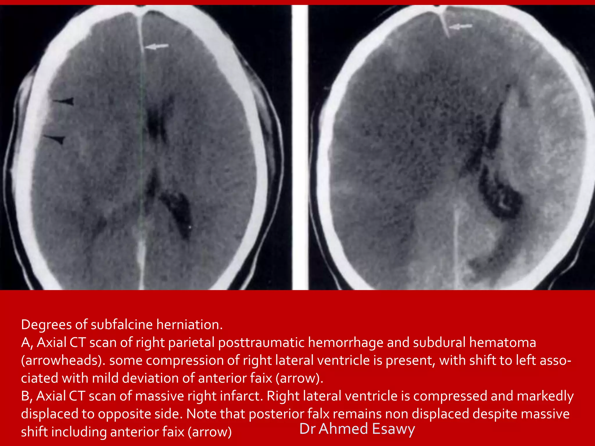 Full story brain herniation imaging Dr Ahmed Esawy | PDF