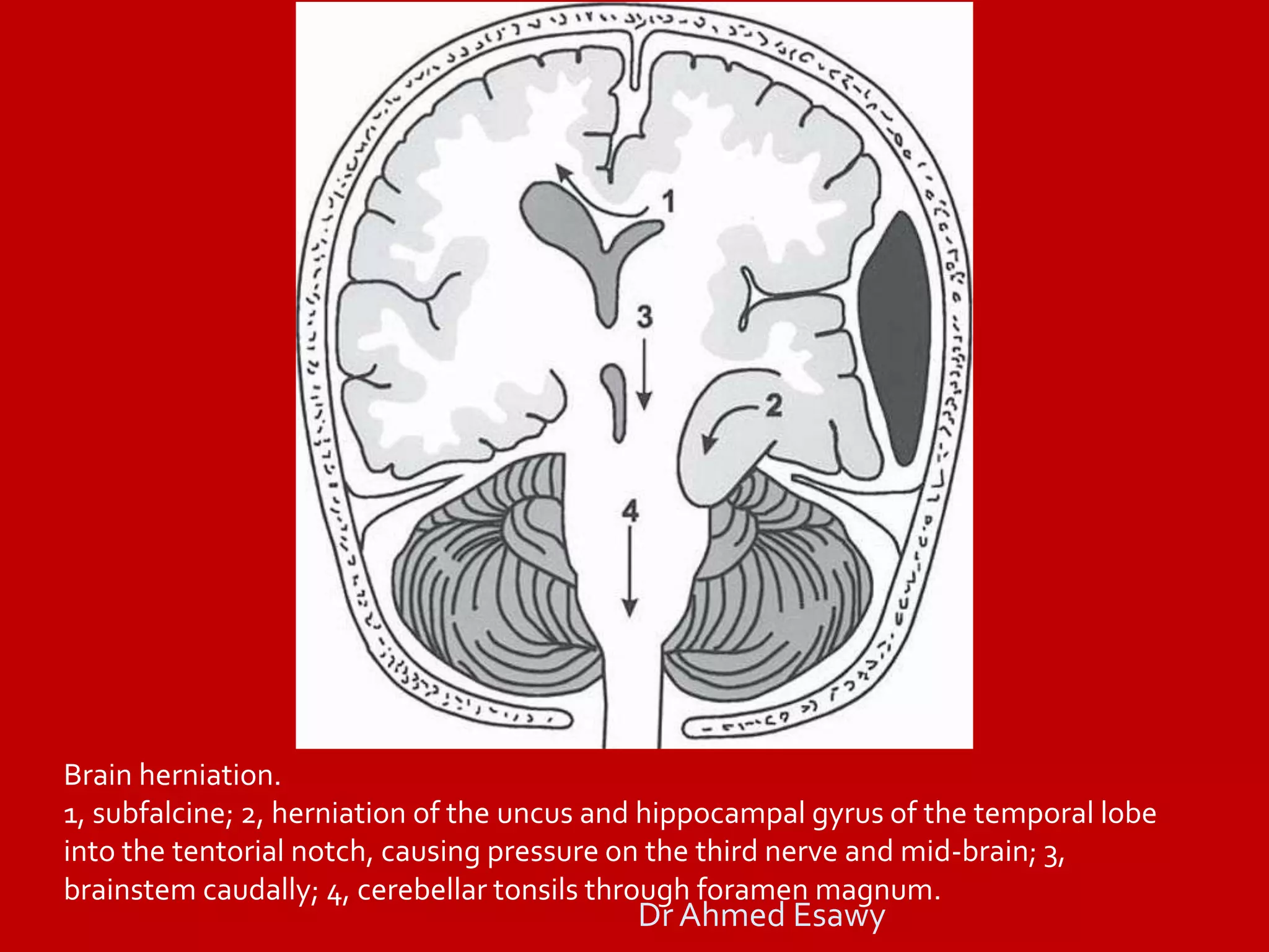 Full story brain herniation imaging Dr Ahmed Esawy | PDF