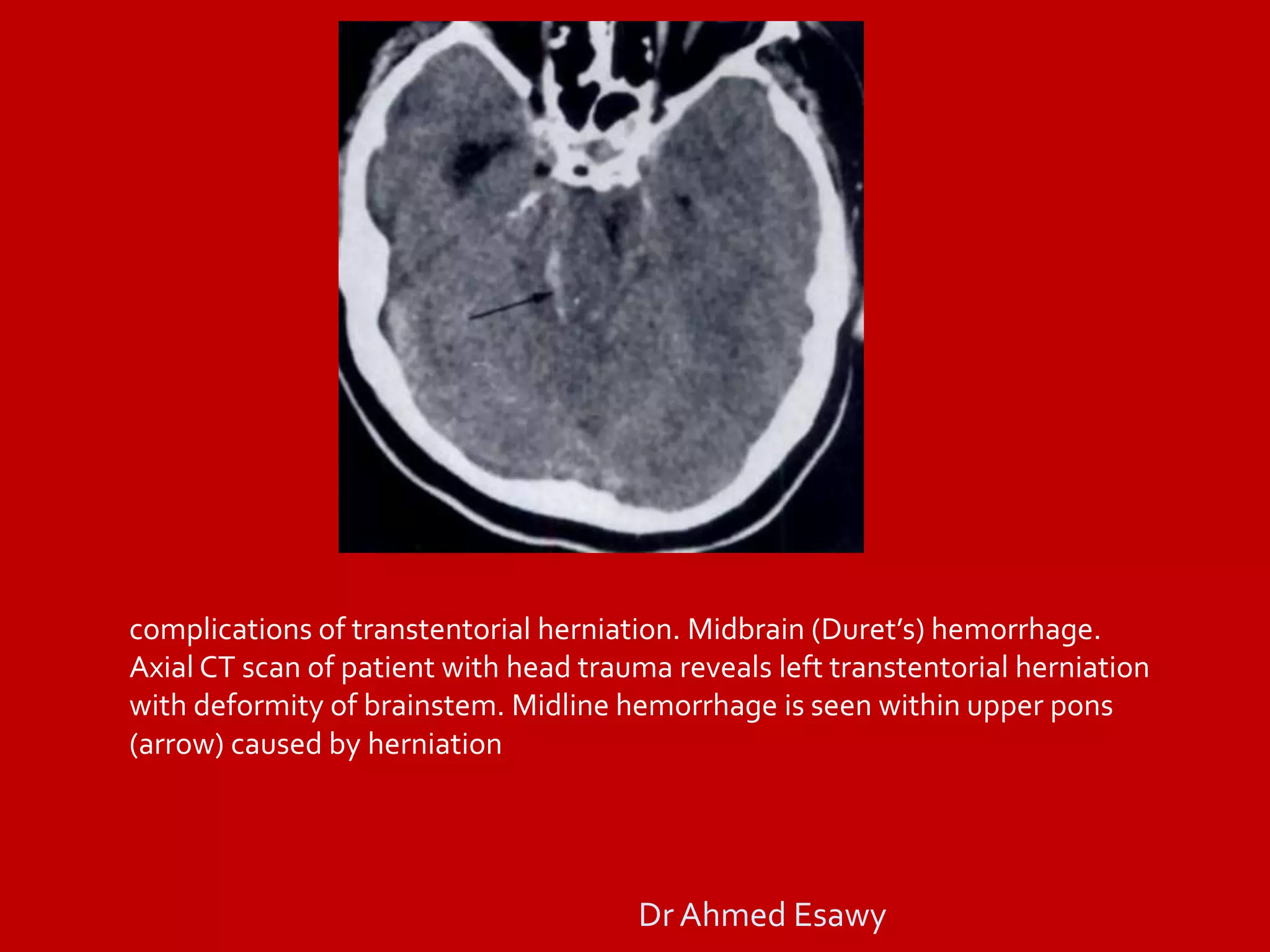 Full story brain herniation imaging Dr Ahmed Esawy | PDF