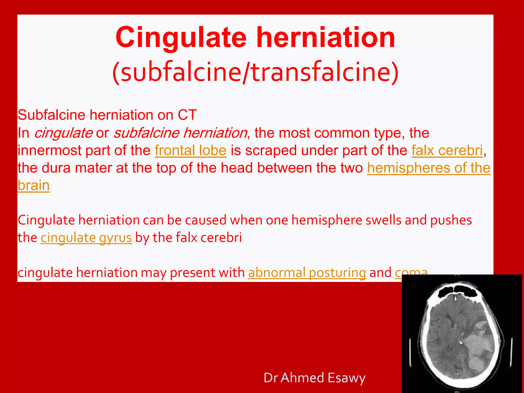 Full story brain herniation imaging Dr Ahmed Esawy | PDF