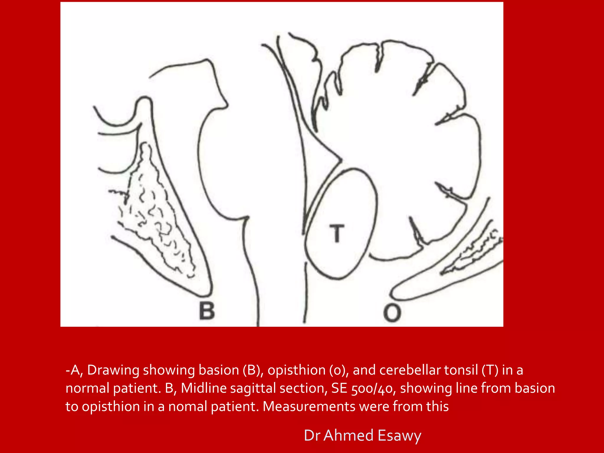 Full story brain herniation imaging Dr Ahmed Esawy | PDF