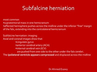 Full story brain herniation imaging Dr Ahmed Esawy | PDF