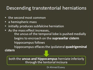 Full story brain herniation imaging Dr Ahmed Esawy | PDF